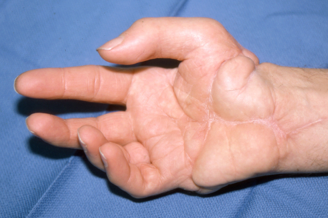 AMPUTATION, HAND | Hand Surgery Resource